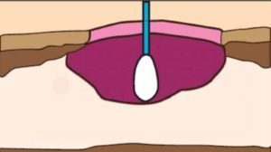 Wound Measurement, Assessment, and Documentation 101 - Swift