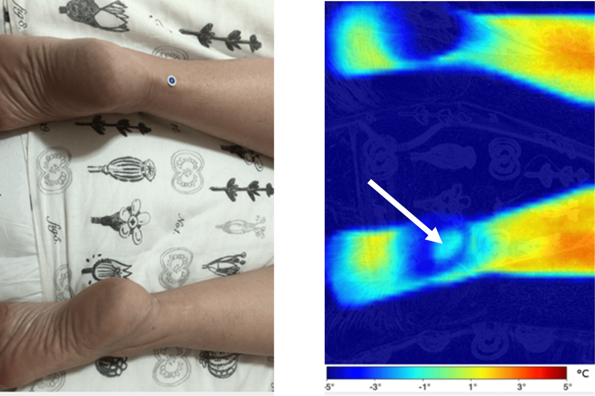 Detect Emerging Pressure Injuries Before they are Visible on the ...